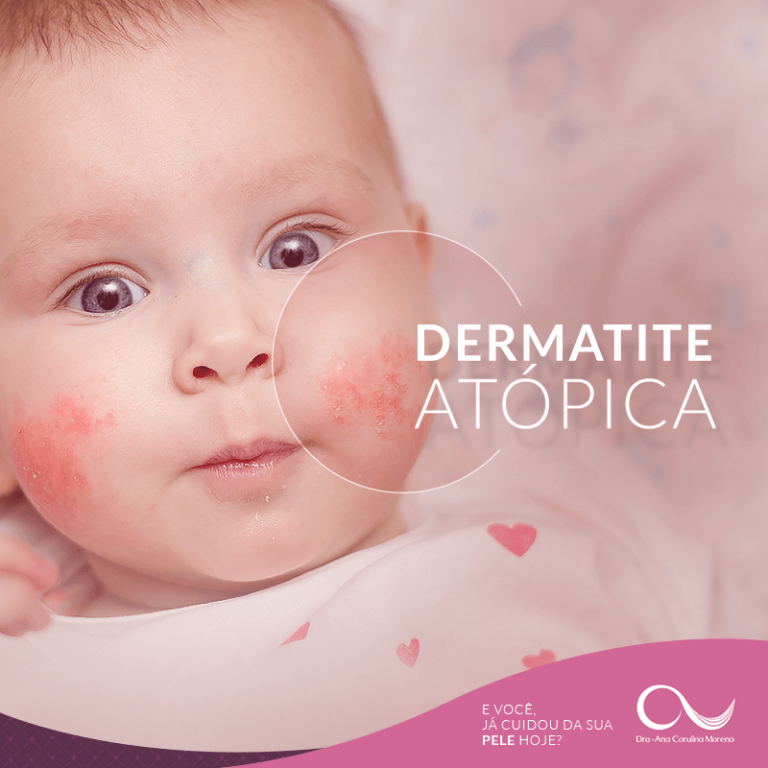 Dermatologia Pediátrica na Barra da Tijuca - Dra. Ana Carulina Moreno