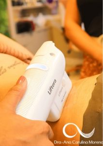 Liftera na Barra da Tijuca - Rio de Janeiro - RJ - Dra. Ana Carulina Moreno